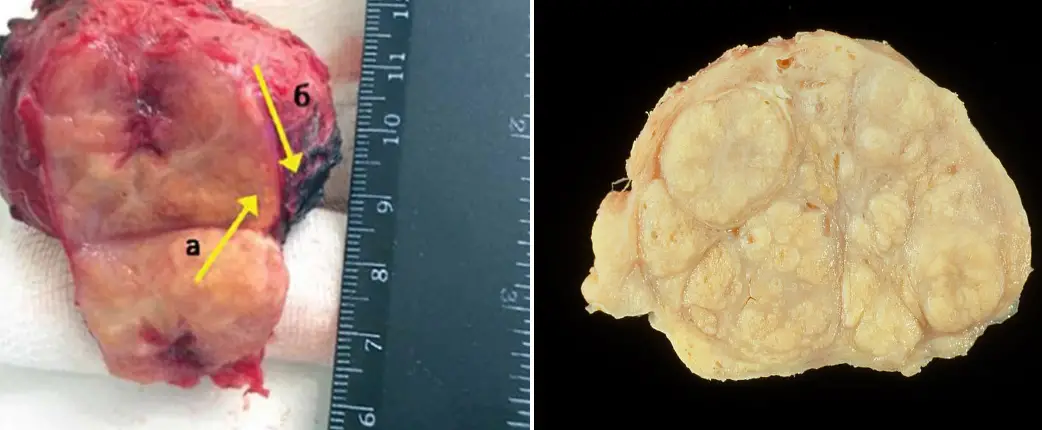 „Upala prostate je izravni put do potpune impotencije i RAKA PROSTATE ...